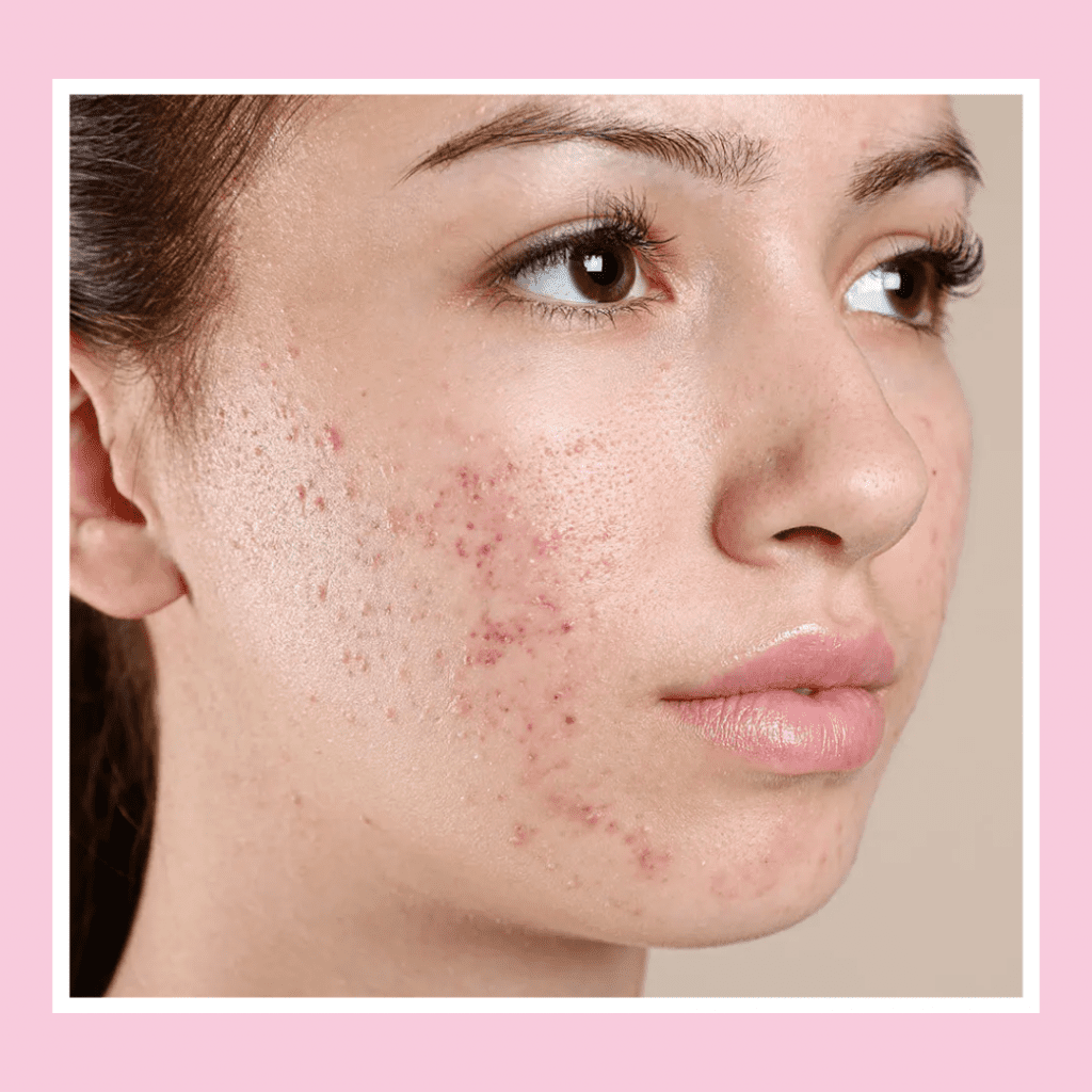 Acne London Acne London