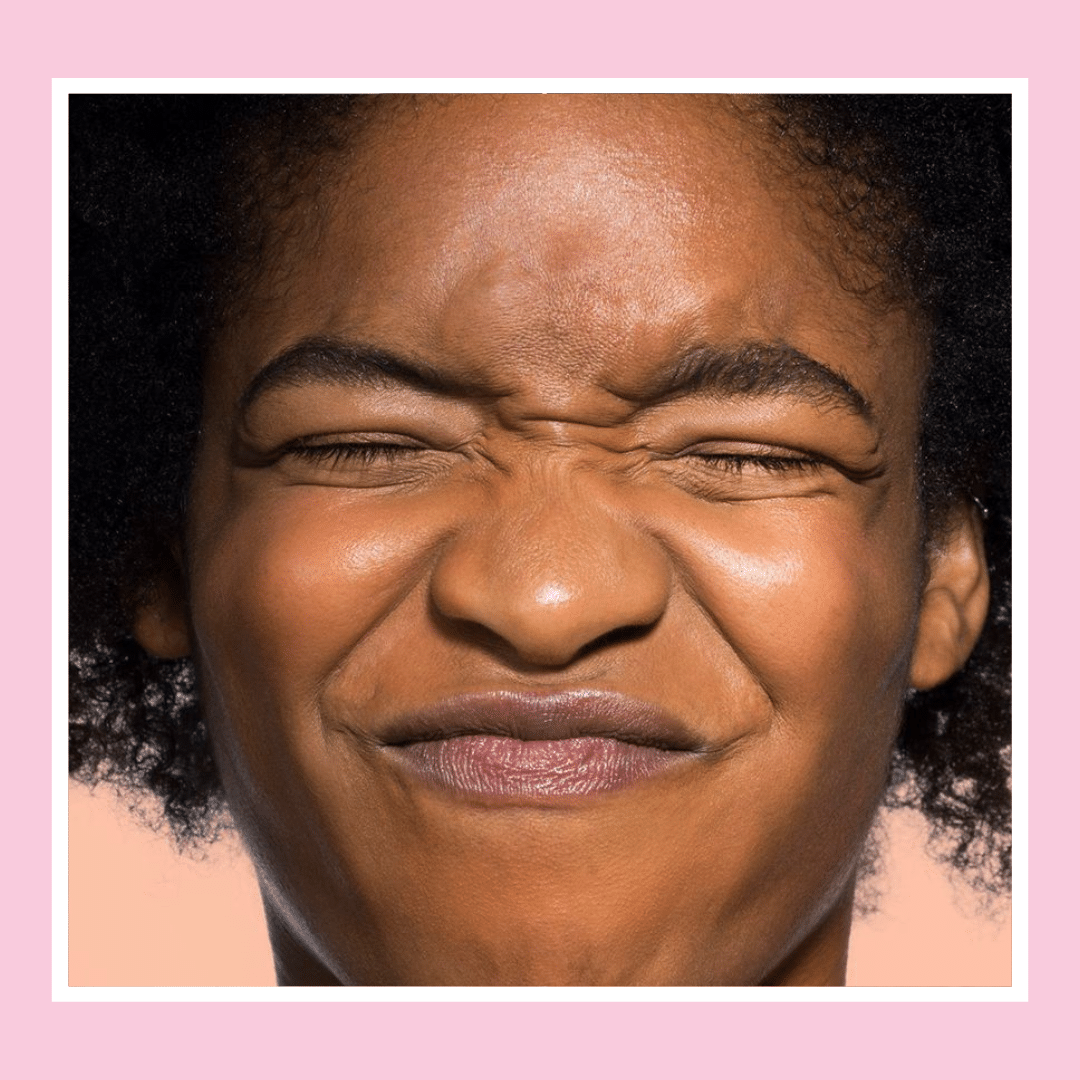 Bunny Lines Treatment in London | Dermal Health