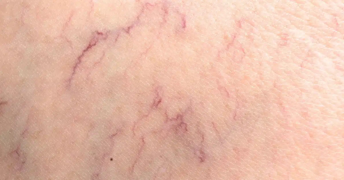 Advanced Solutions for Treating Broken Capillaries, Telangiectasia